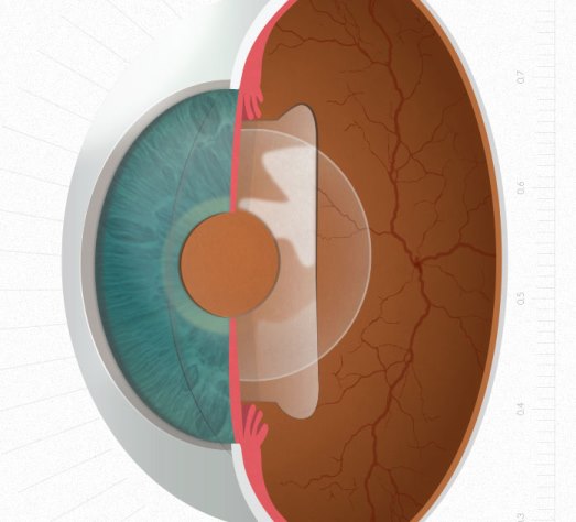 ICL - Nuevas lentes intraoculares para corregir la miopía
